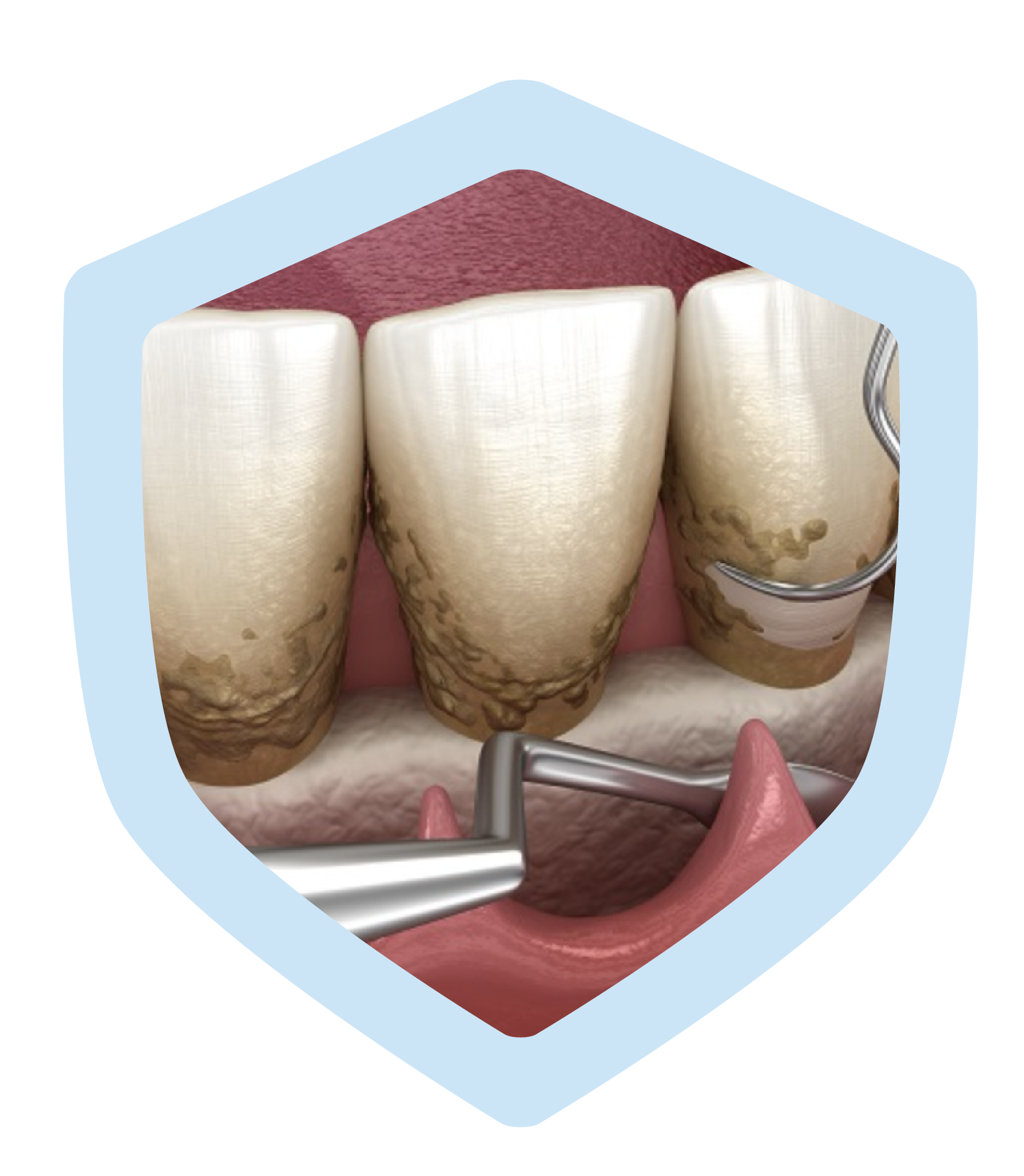 Periodontics – Oral Nova Dent